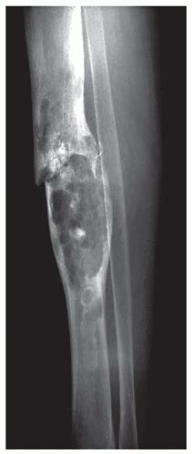 Chondrosarcoma Primary Secondary Dedifferentiated And Clear Cell