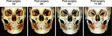 Frontal View Serial Three Dimensional Cone Beam Computed Tomography Download Scientific Diagram