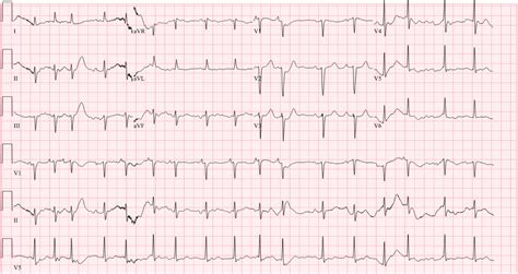 What Is This Irregularly Irregular Rhythm Rekgs