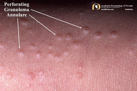 Granuloma Annulare Hands