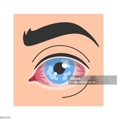 Corneal Herpes Epithelial Eye Disease Stock Illustration Download