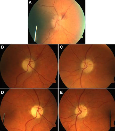 Optic Disc Photographs A Right Optic Disc On Presentation