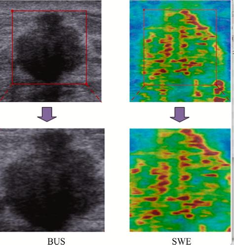 Can An Ai Combination Of Ultrasound And Molecular Data Predict