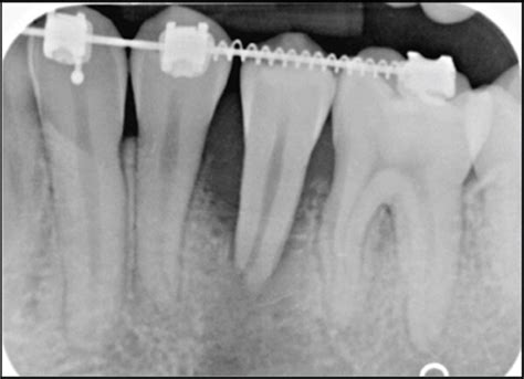 Post Operative Records Of Auto Transplantation A Post Operative