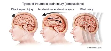 Sports Tbi Horizon Tbi And Brain Center