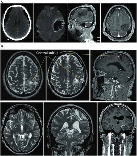 Illustration Of The Brain Lesion Of Mr I Panel A Onset Ct Scan Of