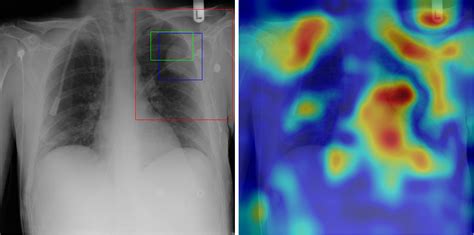 170502315 Chestx Ray8 Hospital Scale Chest X Ray Database And