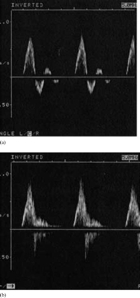 Femoral Artery Doppler Waveforms A From The Non Download
