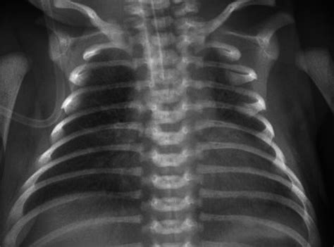 Abca3 Mutation Induced Congenital Pulmonary Surfactant Deficiency A Case Report Pmc