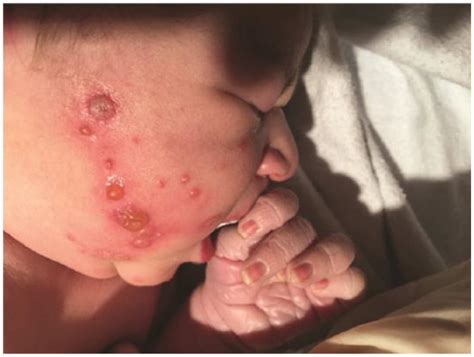 Neonatal Group B Strep Rash