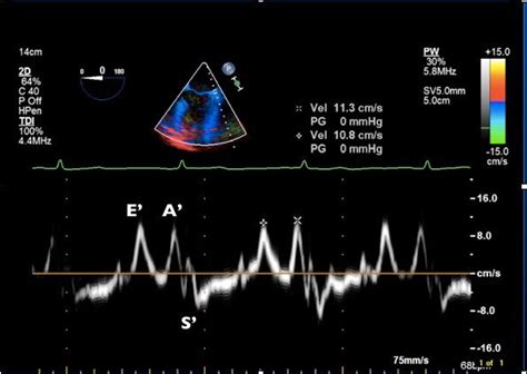 How To Perform Tissue Doppler Measurements Duke Department Of