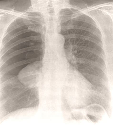 The Interpretation Of Chest X Rays For Pneumothorax Detection A