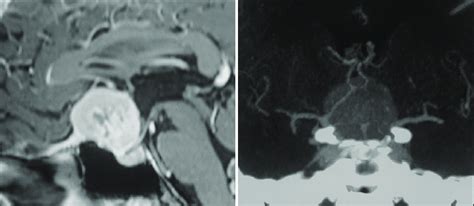 A Mri And B Cta Showing Densely Enhancing 4 Cm Tuberculum