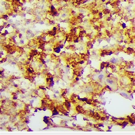Tumor Cells Showing A High Expression Of Mmp9 Ihc 400x Ihc