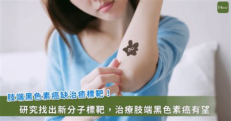 治療肢端黑色素癌有望！研究揪出新分子標靶「與黑色素皮膚癌大不同」 Heho Cancer