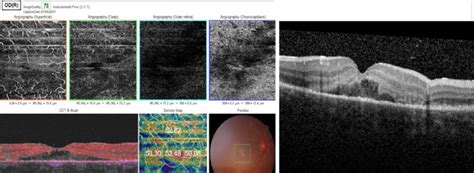 OCT And OCTA Imaging At The 1st Day After Trauma To The Right Eye A