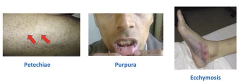 Disorders Of Hemostasis Flashcards Quizlet