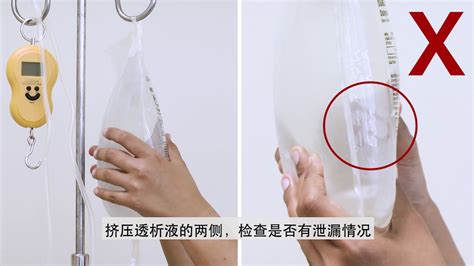 Ambulatory Peritoneal Dialysis CAPD Step By Step Guide Mandarin