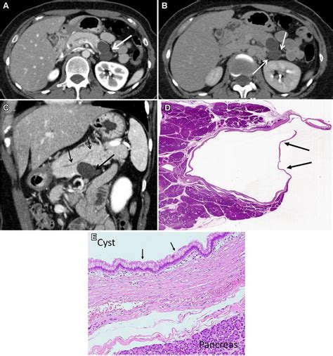 A 41 Year Old Female With Mnnc In The Pancreatic Tail A The Pancreatic