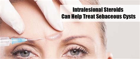 Skin Cyst Types Risk Factors Causes Symptoms Complications