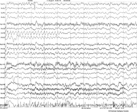 Partial Seizure Eeg
