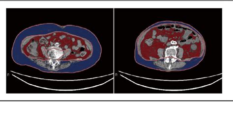 Measurement Of Intraabdominal Fat Area Using Multi Detector Computed Download Scientific
