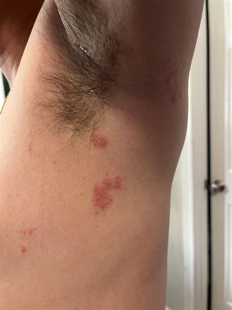 Bed Bugs Or Allergic Reaction Rdermatologyquestions