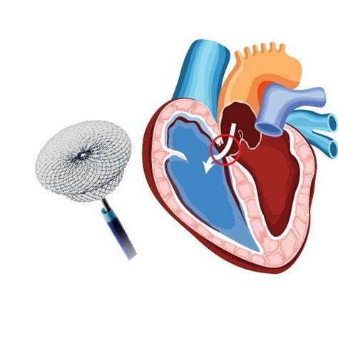 Device Closure For Patent Ductus Arteriosus Patent Ductus Arteriosus