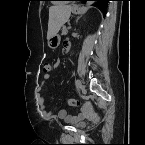 Filedistal Colocolic Intussusception Due To Lipoma Epiploic