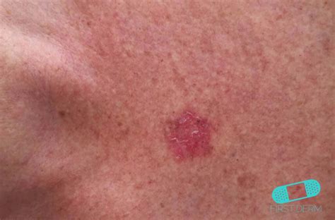 Tratamientos Para Carcinoma De Células Escamosas De La Piel Compartir