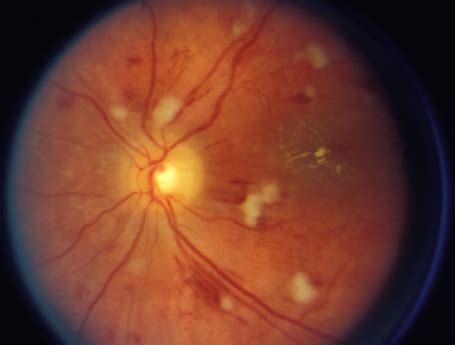 Retinopathy Retinopathy With Splinter Hemorrhages
