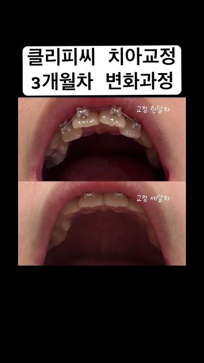클리피씨 전체치아교정 3개월 변화 Youtube