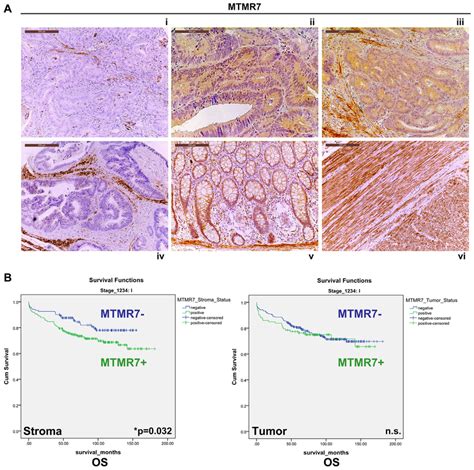 Expression And Prognostic Significance Of MTMR7 In CRC Patients A