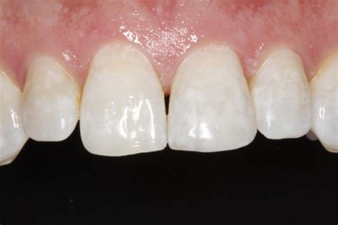Four Products To Immediately Improve Your Composite Restorations