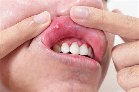 Prevent Mouth Ulcers Tlc Womens Center