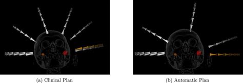 Improving The Efficiency Of Single Isocenter Multiple Metastases Stereotactic Radiosurgery