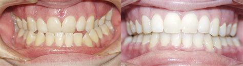 Before And After York ME Atlantic Orthodontic Center