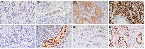 Representative Examples Of Her2 P53 And Ki67 Status A Negative