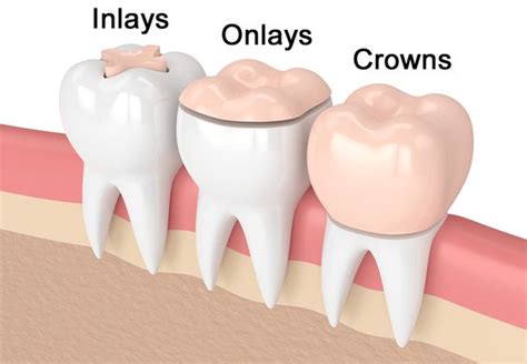Discovery Dental Centre Inlays Onlays And Crowns Are All Custom Fabricated Outside Of The
