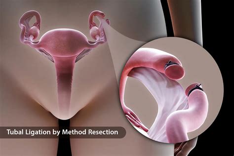 Tubal Ligation Pros And Cons Of Getting Your Tubes Tied
