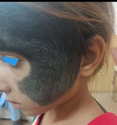Hairy Nevus Surgery