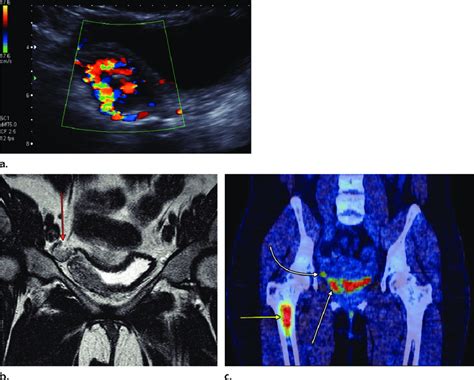 Malignant Bladder Pgl In A 23 Year Old Woman Who Presented With A Download Scientific Diagram