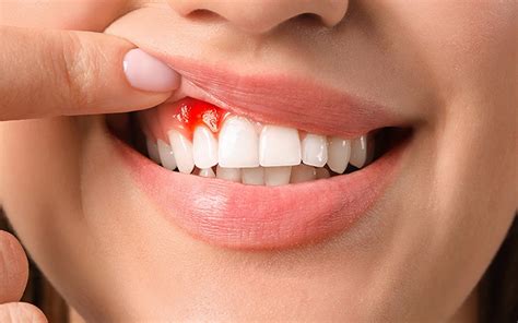 Chảy Máu Chân Răng Thường Xuyên Cảnh Báo điều Gì Nha Khoa