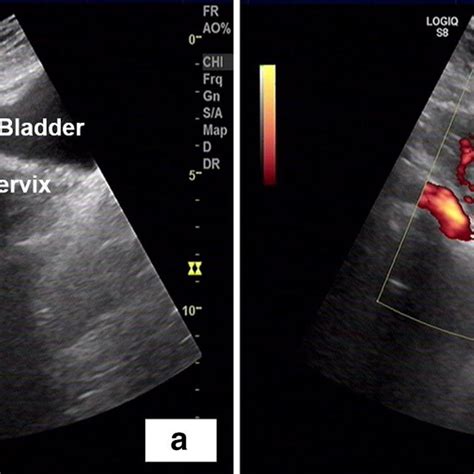 A Two Dimensional Sagittal Ultrasonogram Showed That The Serosal