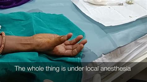 Trigger Finger Treatment Causes No Surgery Without Surgery Simple
