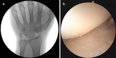 Arthroscopic Proximal Row Carpectomy Musculoskeletal Key
