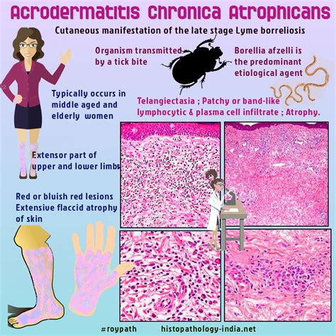 Pathology Of Acrodermatitis Chronica Atrophicans Homeopatía