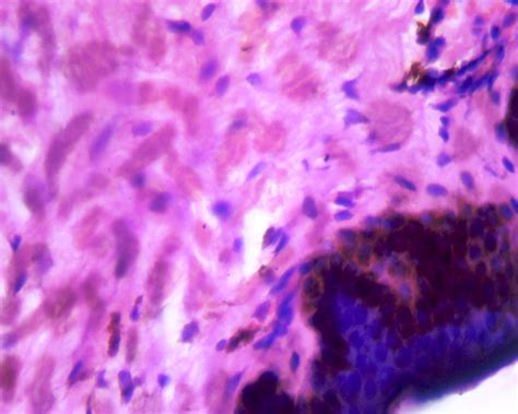 Pseudoxanthoma Elasticum Histology