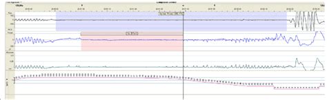 A 2 Minute Epoch Showing A Prolonged Mixed Apnea Followed By A Profound