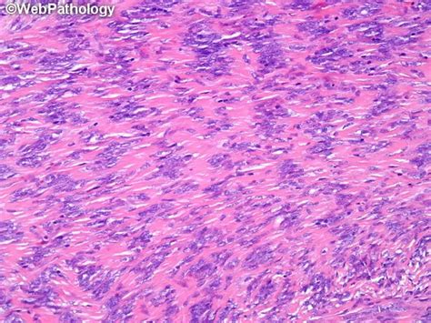 Synovial Sarcoma